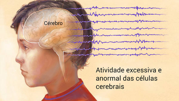 CONVULSÃO NA ESCOLA, O QUE O PROFESSOR PRECISA SABER? - Creche Segura